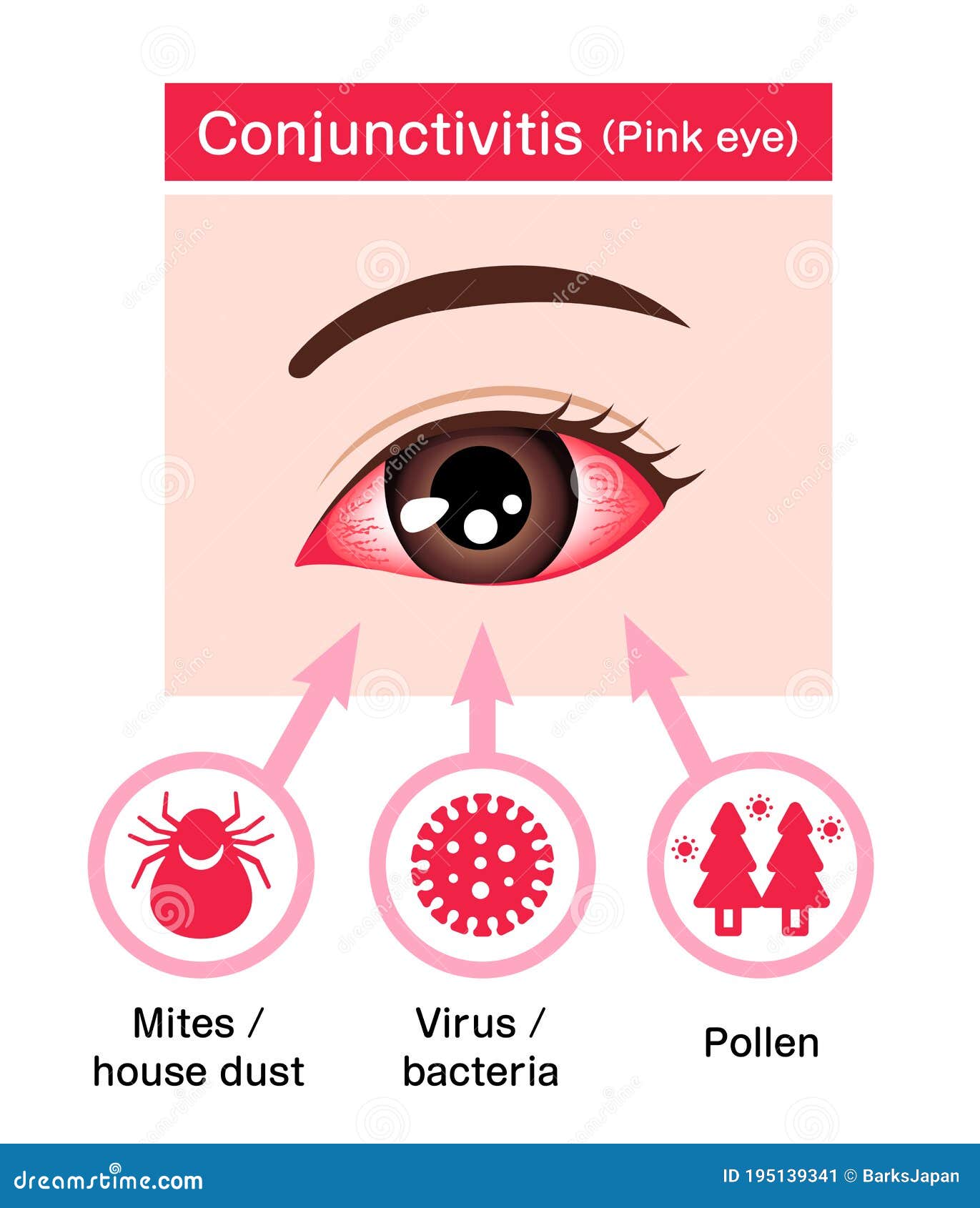Conjunctivitis Or Pink Eye Causes, Symptoms And Treatment Outline ...