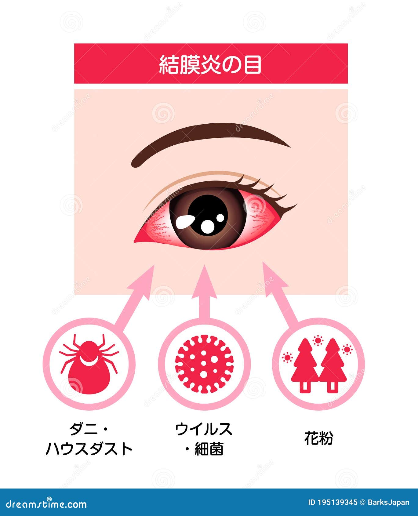 Causes of Conjunctivitis Pink Eye Vector Illustration Stock Vector - Illustration of medical ...