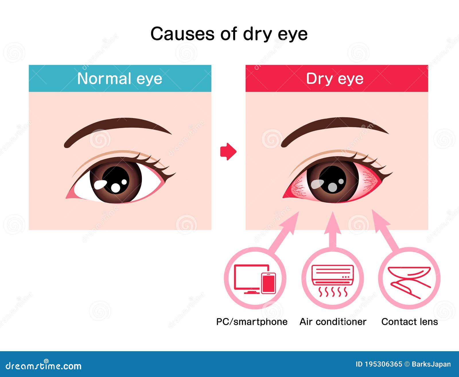 Causes of Dry Eye Vector Illustration Stock Vector - Illustration of ...