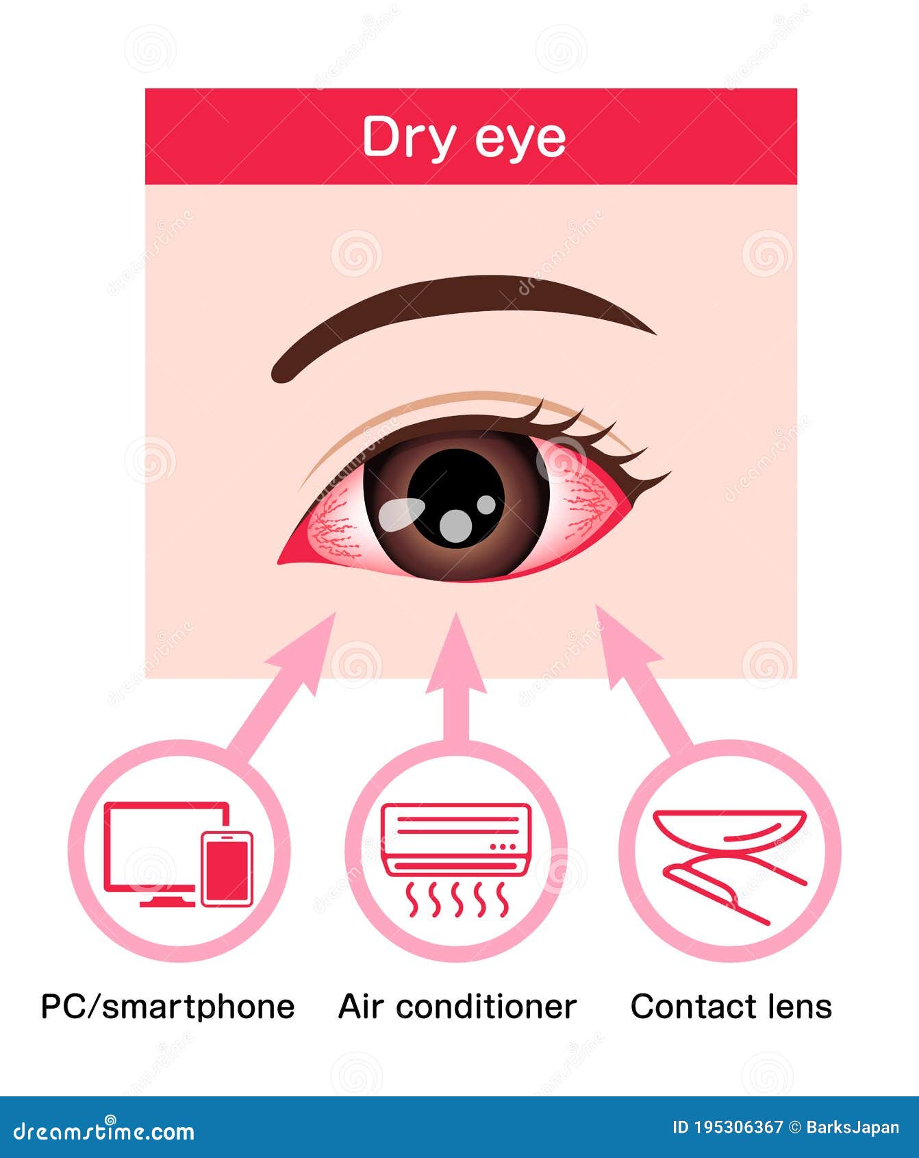 Causes Of Conjunctivitis Pink Eye Vector Illustration | CartoonDealer ... Causes Of Conjunctivitis Pink Eye Vector Illustration | CartoonDealer ...