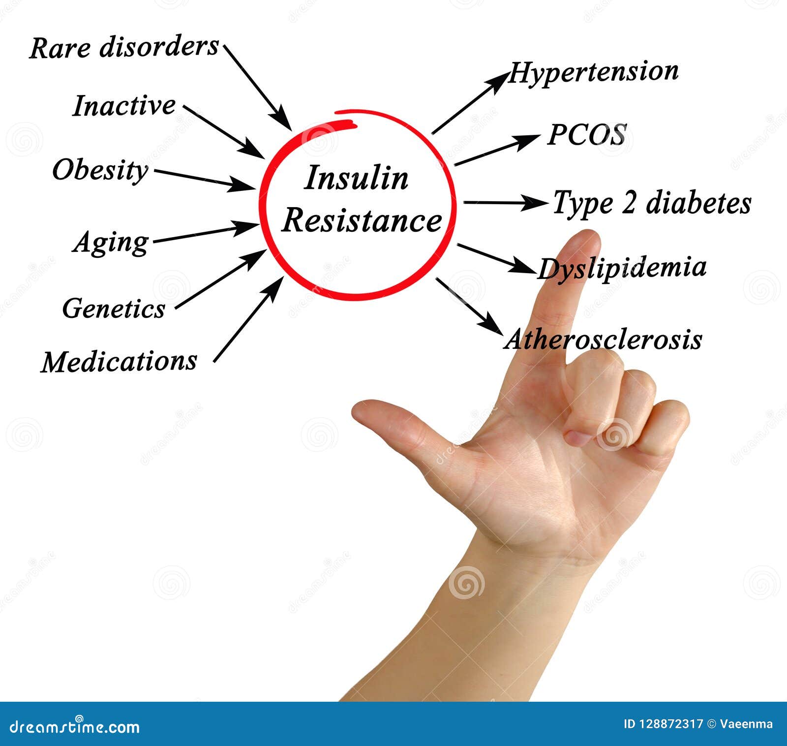 Causes and Effects of Insulin Resistance Stock Image - Image of disease ...