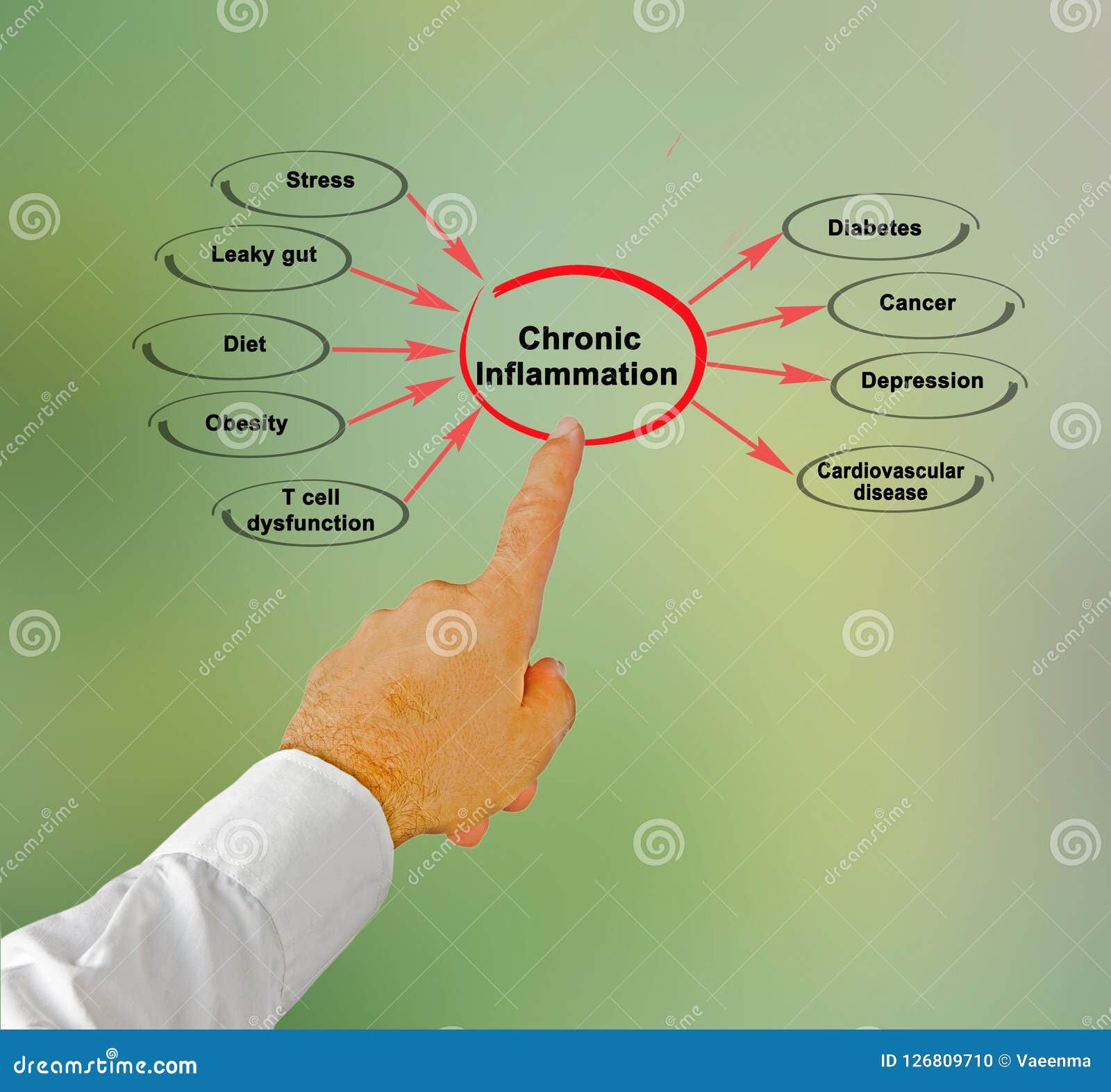 Causes Et Effet De L'inflammation Chronique Photo stock - Image du ...