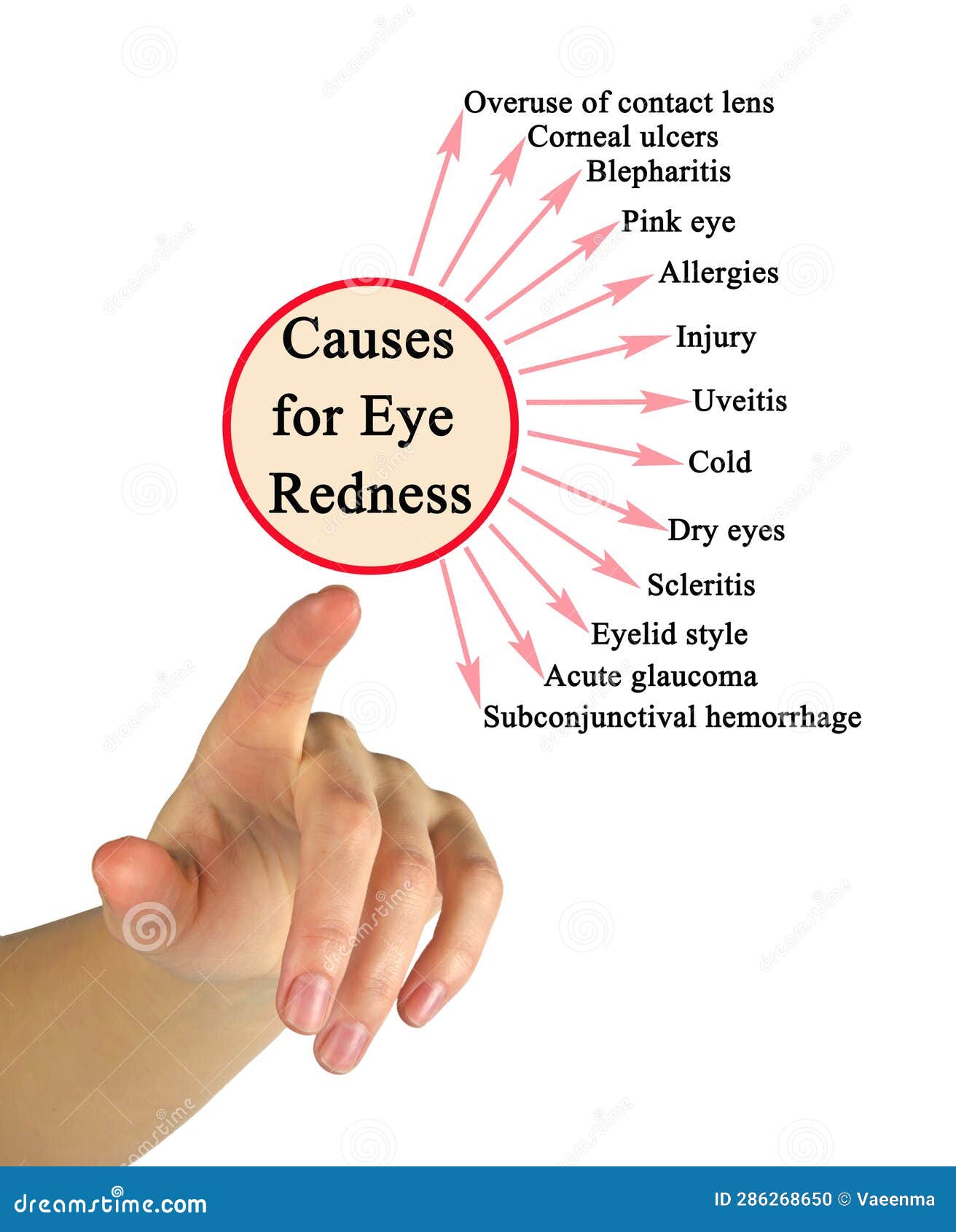 13 Causes for Eye Redness stock photo. Image of ulcers - 286268650