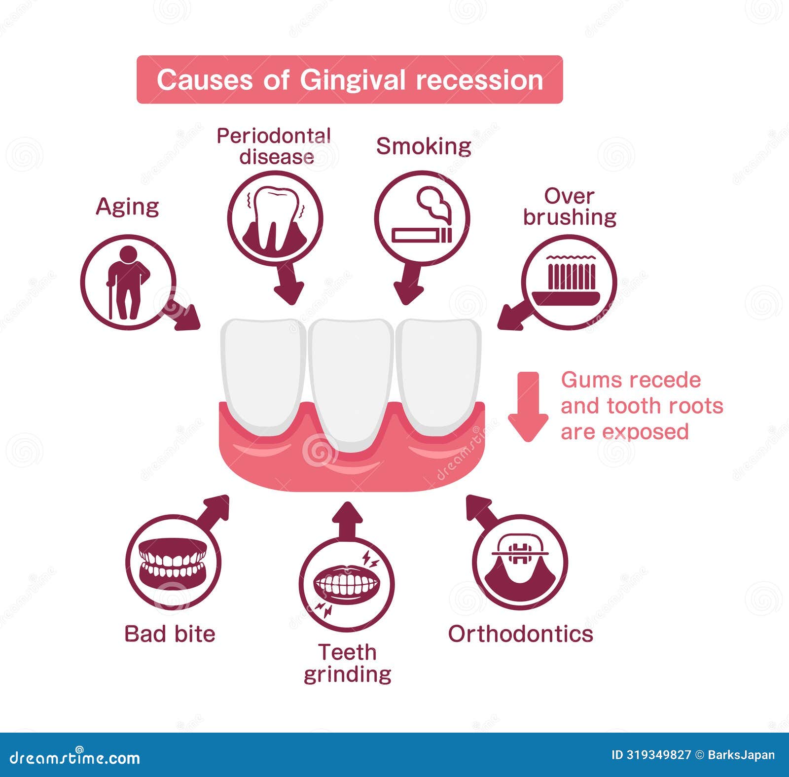 Causes of Gingival Recession. Vector Illustration Stock Vector ...