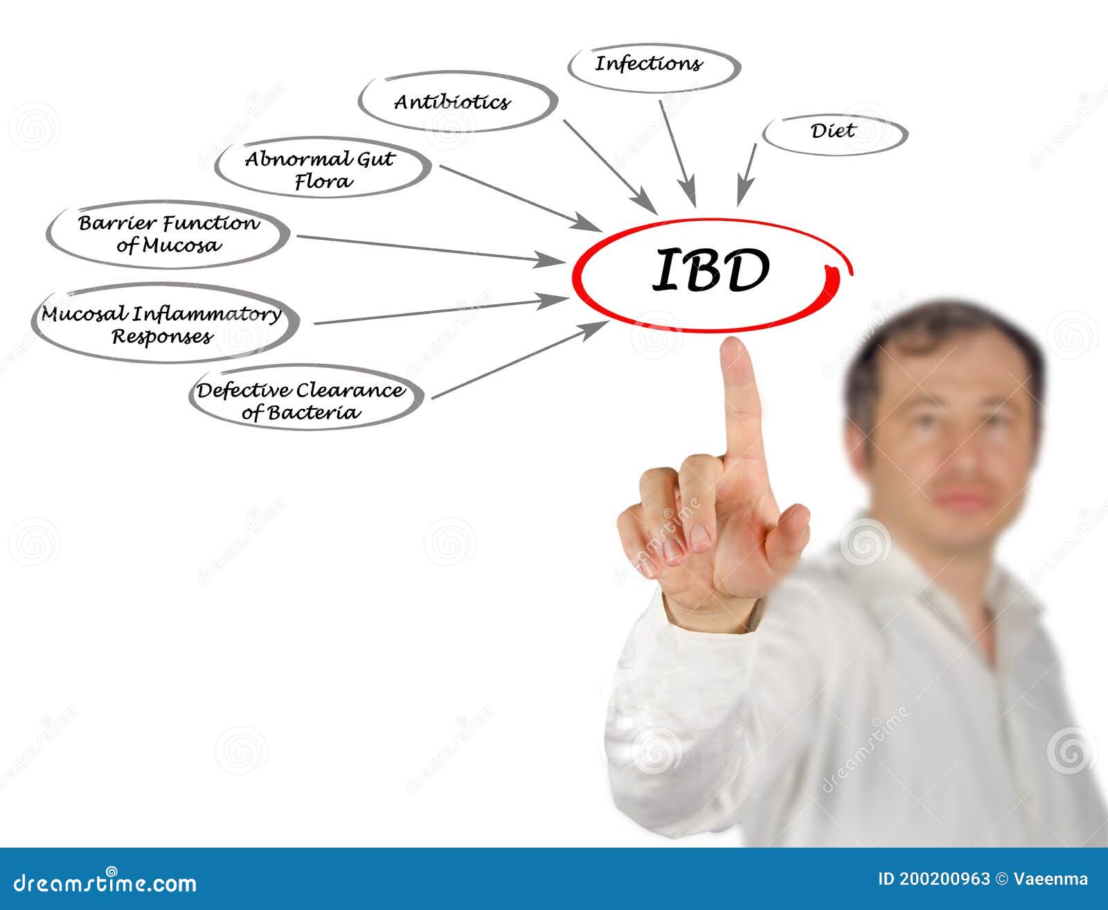 Causes of Inflammatory Bowel Disease Stock Image - Image of doctor ...