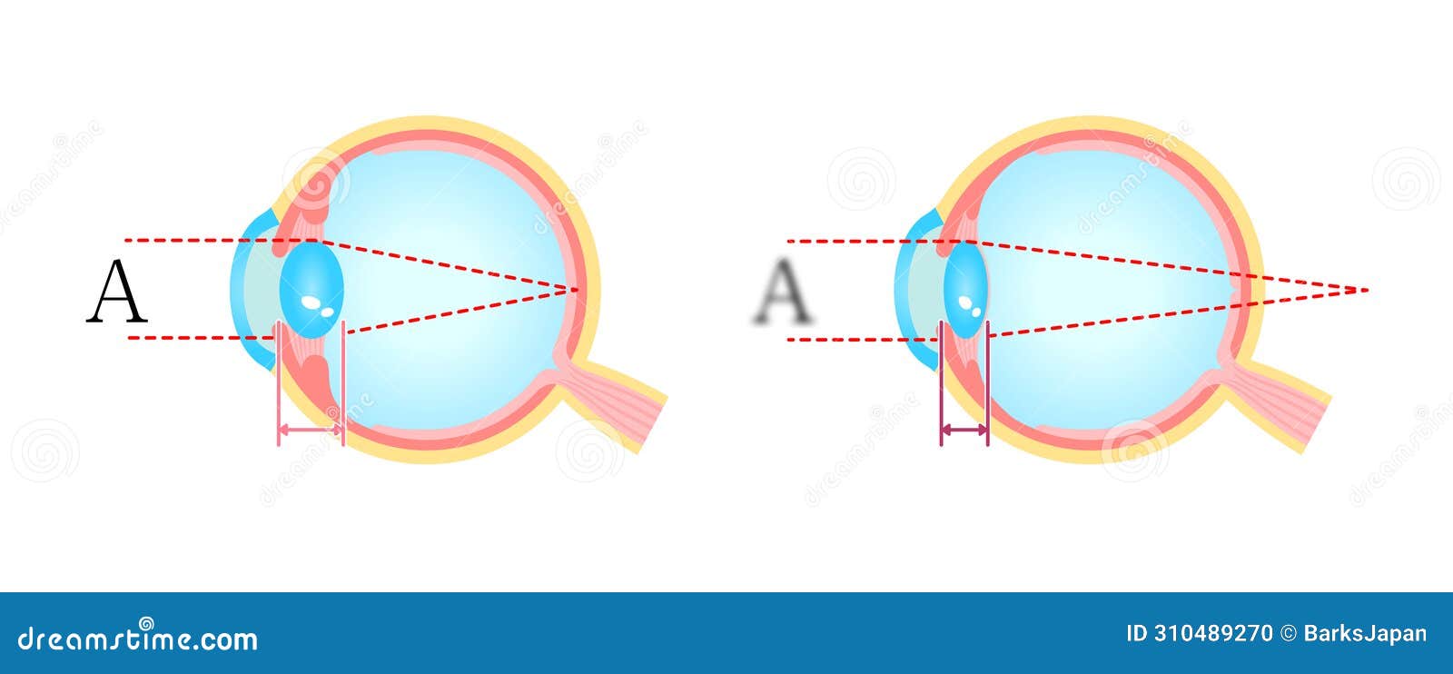Causes and Mechanism of Cataract Illustration Stock Vector ...