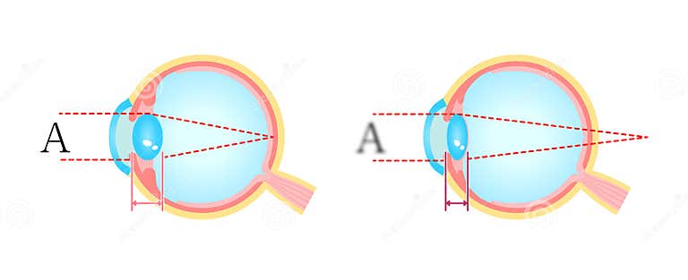 Causes and Mechanism of Cataract Illustration Stock Vector ...