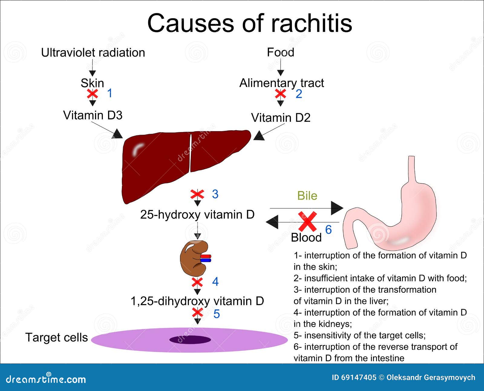 Causes Of Rachitis Stock Illustration - Image: 69147405