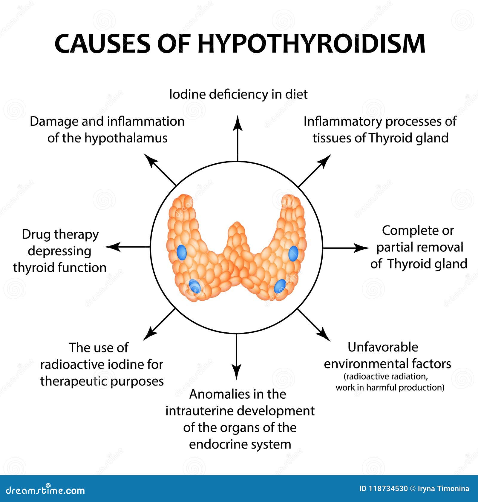 The Causes of Thyroid Hypothyroidism. Infographics. Vector Illustration ... The Causes of Thyroid Hypothyroidism. Infographics. Vector Illustration ...