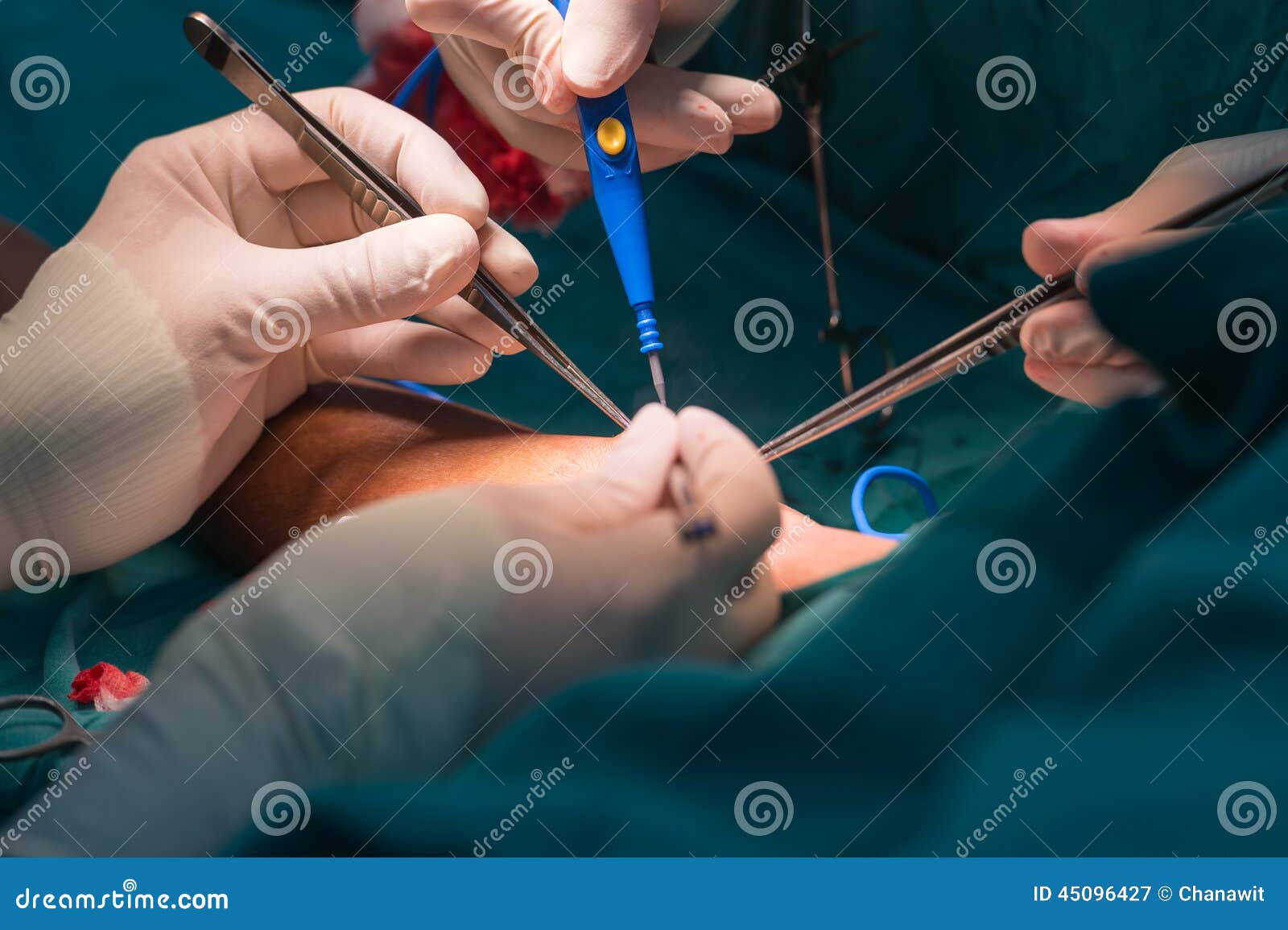 Cauterization After Surgery