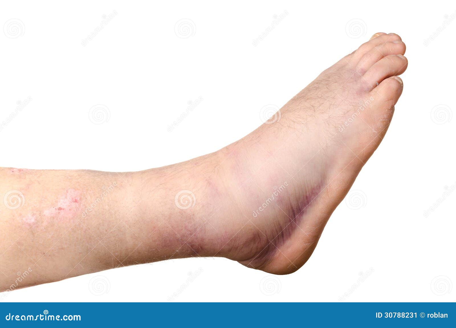 Caviglia rotta immagine stock. Immagine di danneggiato - 30788231