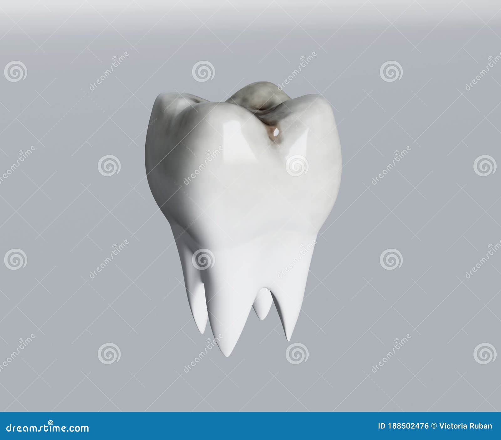 Cavities of molar tooth stock illustration. Illustration of crown ...