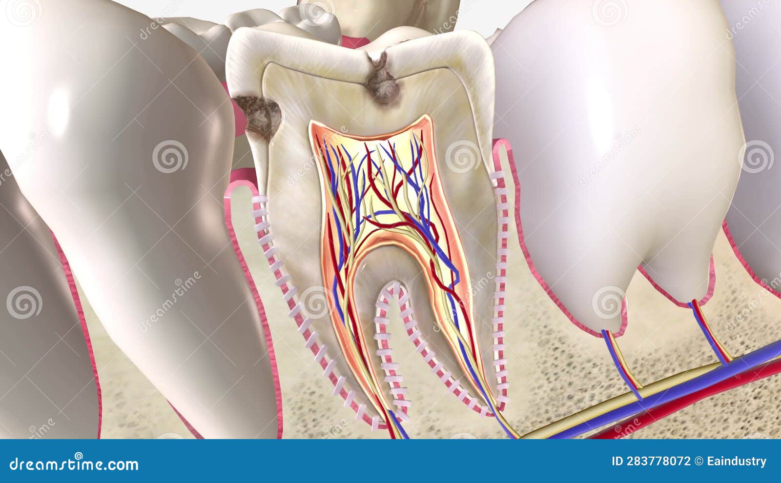 Cavities are Permanently Damaged Areas in the Hard Surface of Your ...