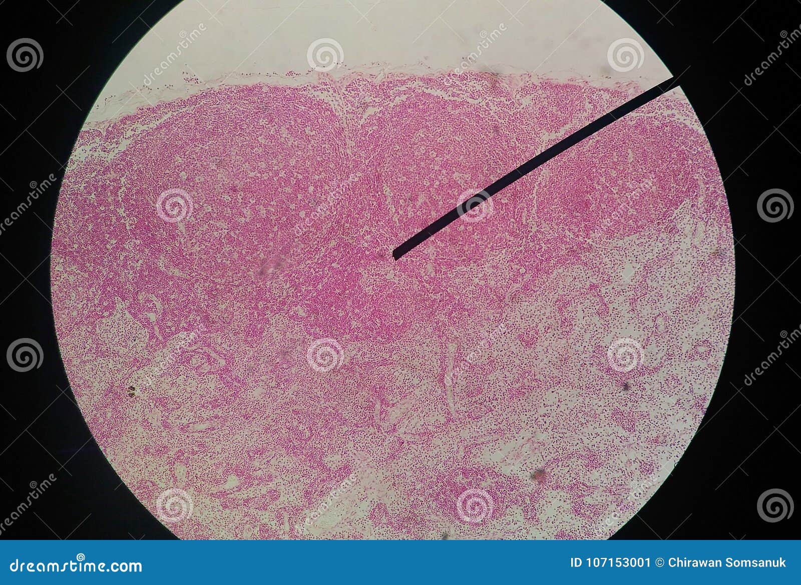 Cells Of A Human Thyroid Gland With Swelling Under A Microscope Royalty ...