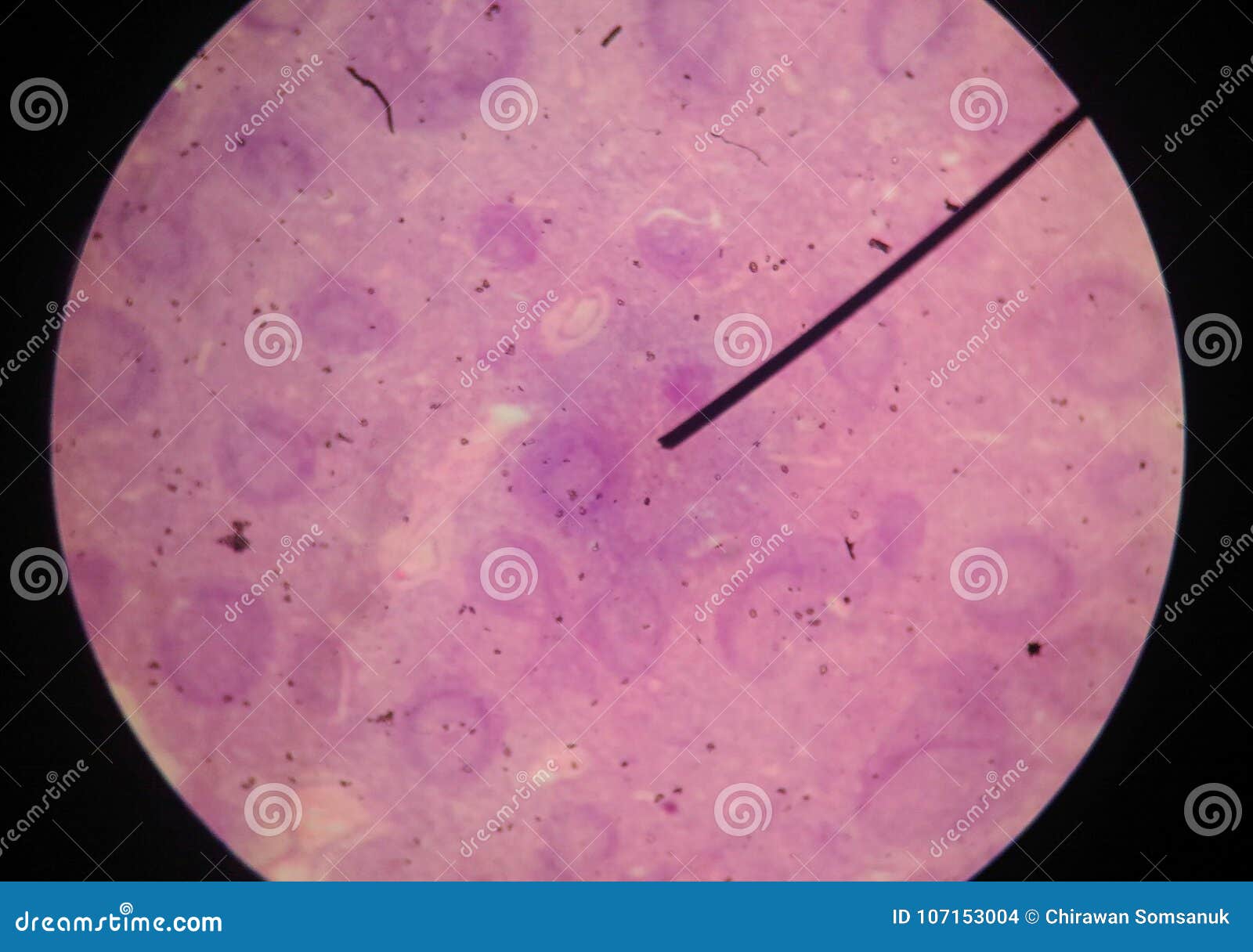 Cells Of A Human Thyroid Gland With Swelling Under A Microscope Royalty ...