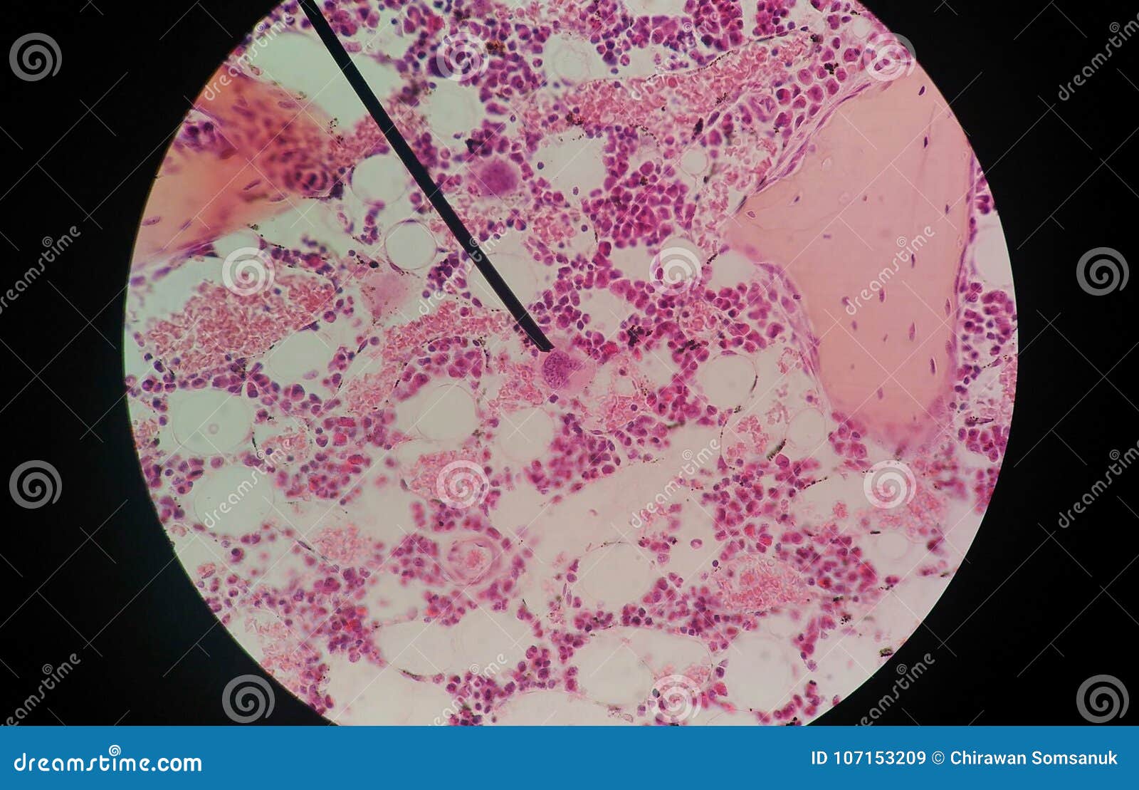 Cells Of A Human Thyroid Gland With Swelling Under A Microscope Royalty ...