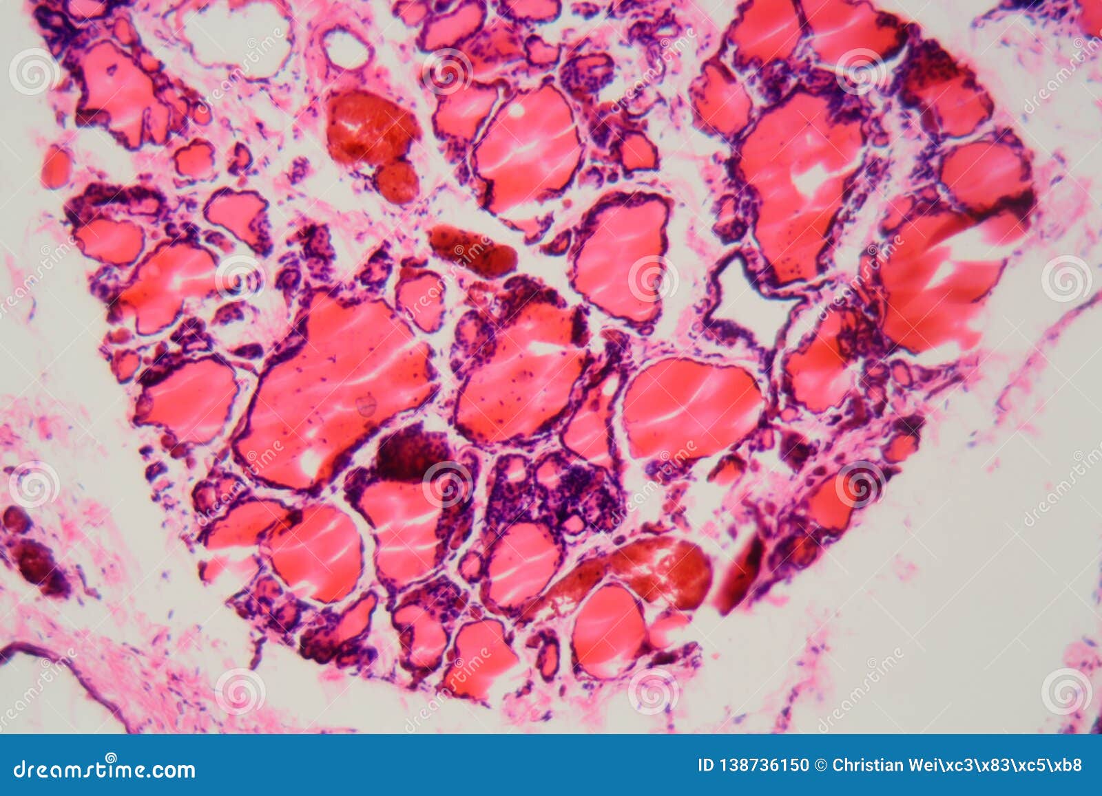 Human Thyroid Gland with Goiter Caused by Deficiency of Iodine Under a ...