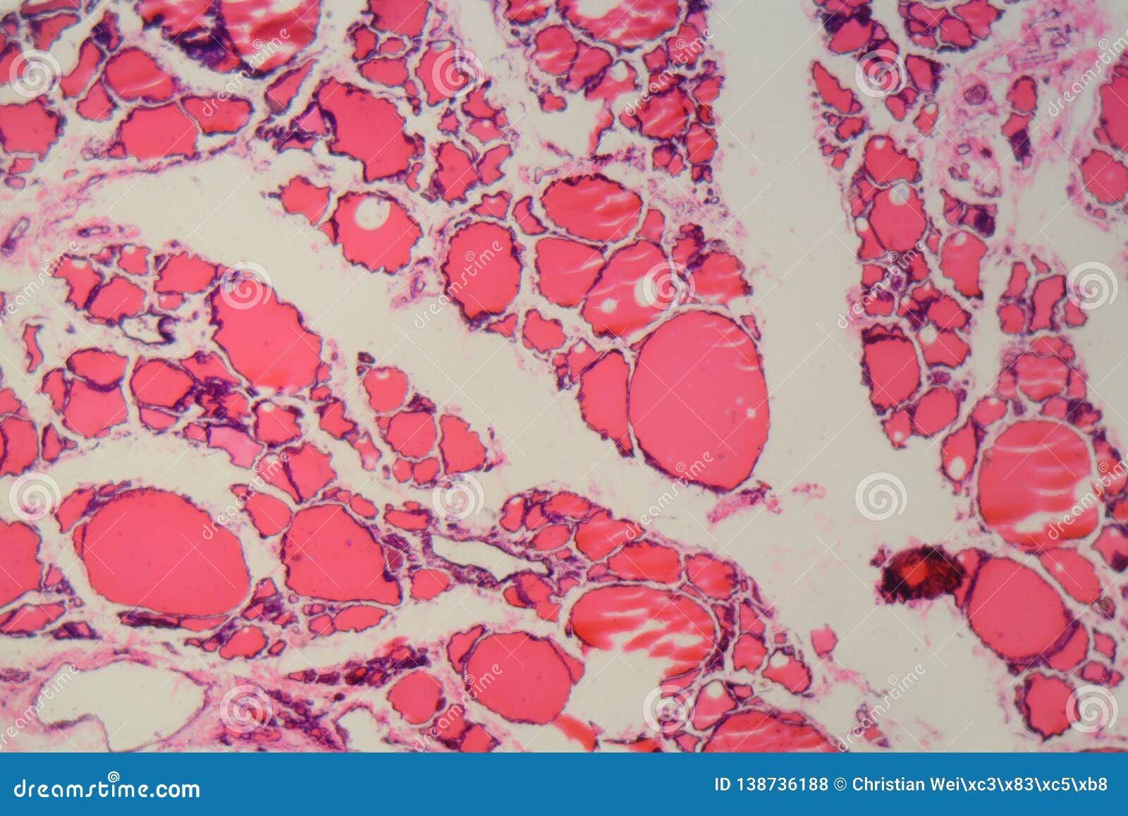 Human Thyroid Gland with Goiter Caused by Deficiency of Iodine Under a ...