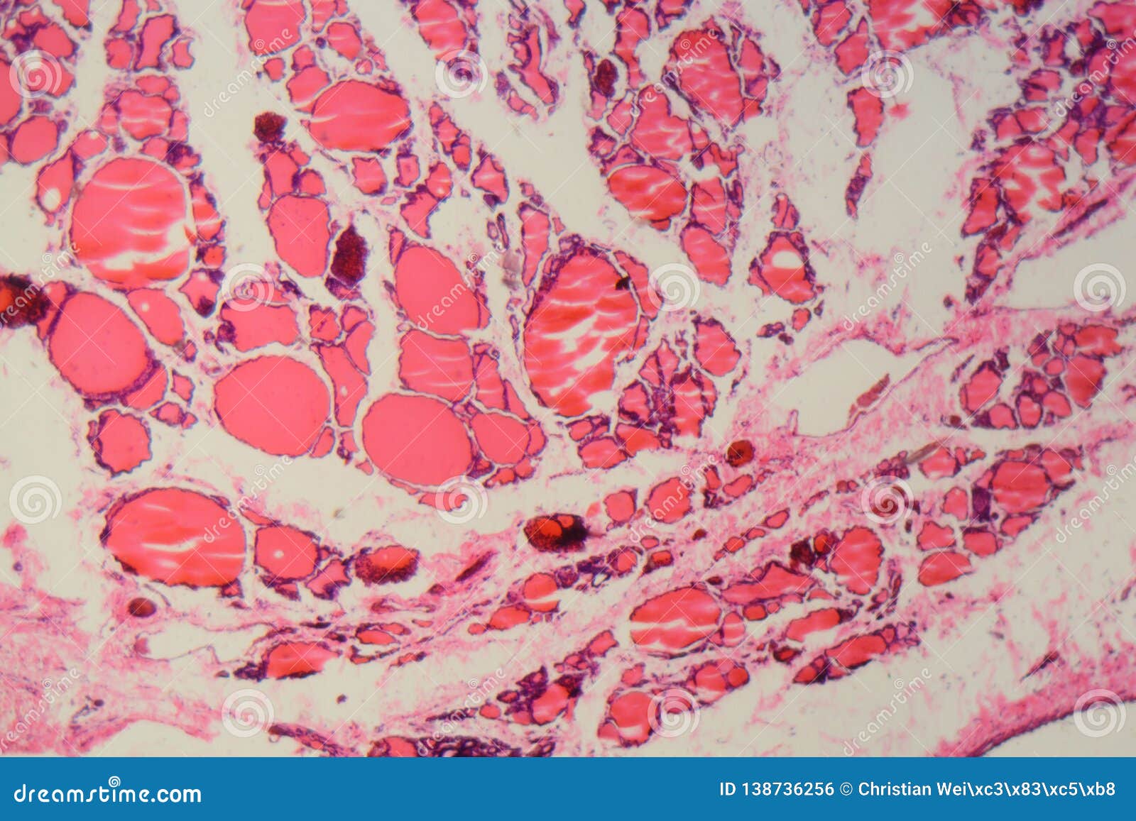 Human Thyroid Gland with Goiter Caused by Deficiency of Iodine Under a ...