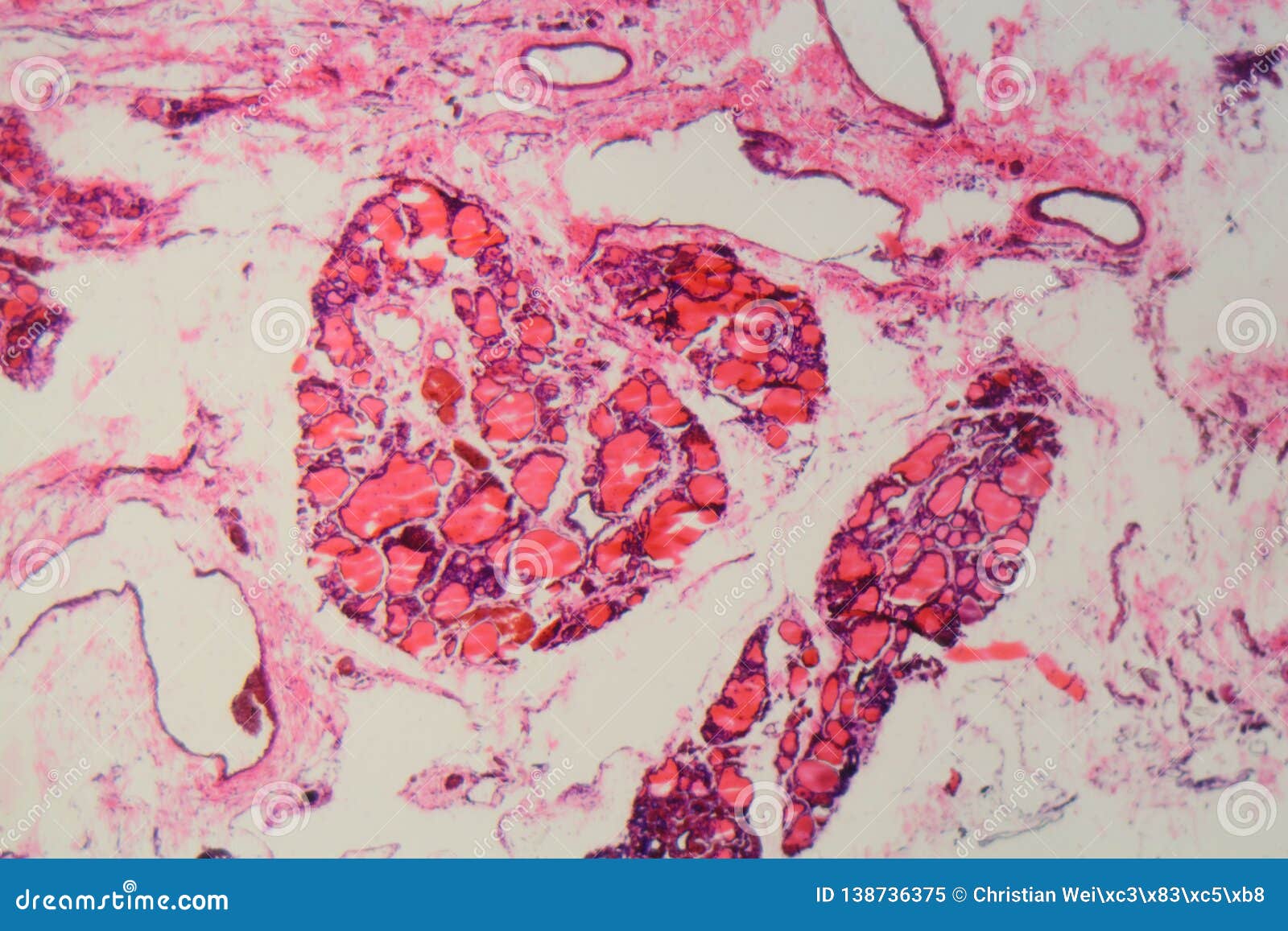 Human Thyroid Gland with Goiter Caused by Deficiency of Iodine Under a ...