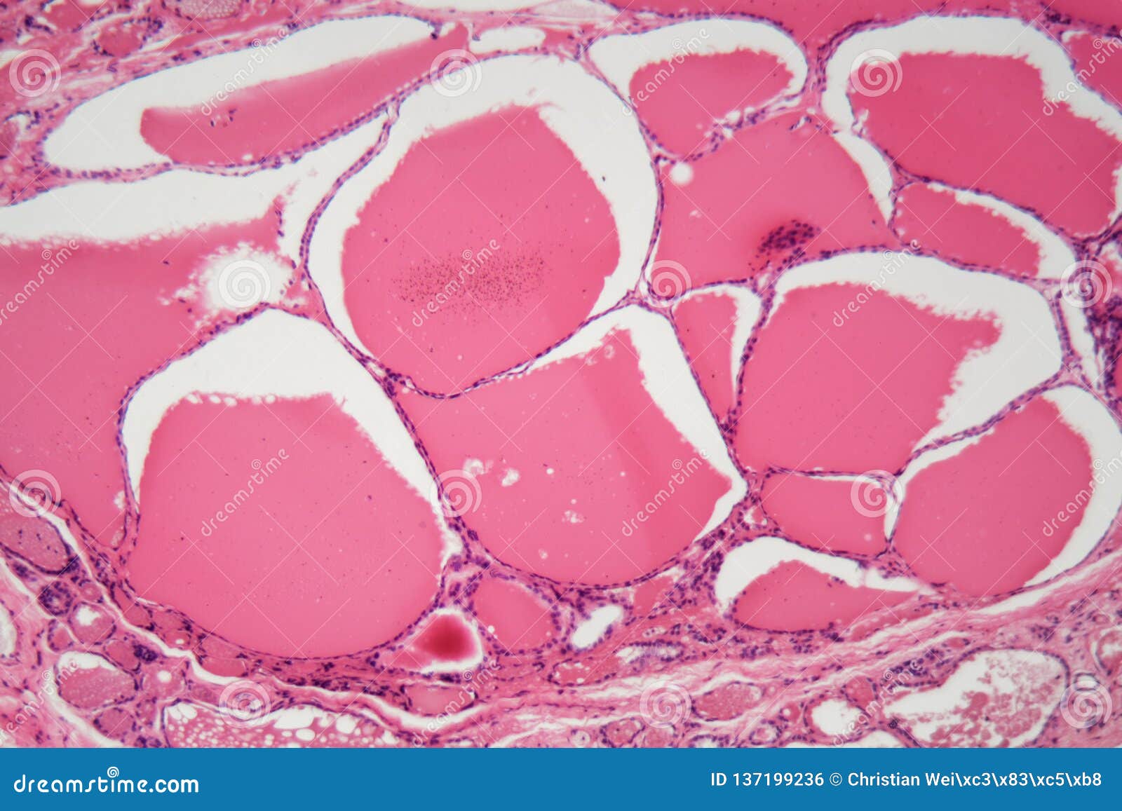 Cells of a Human Thyroid Gland with Swelling Under a Microscope Stock ...