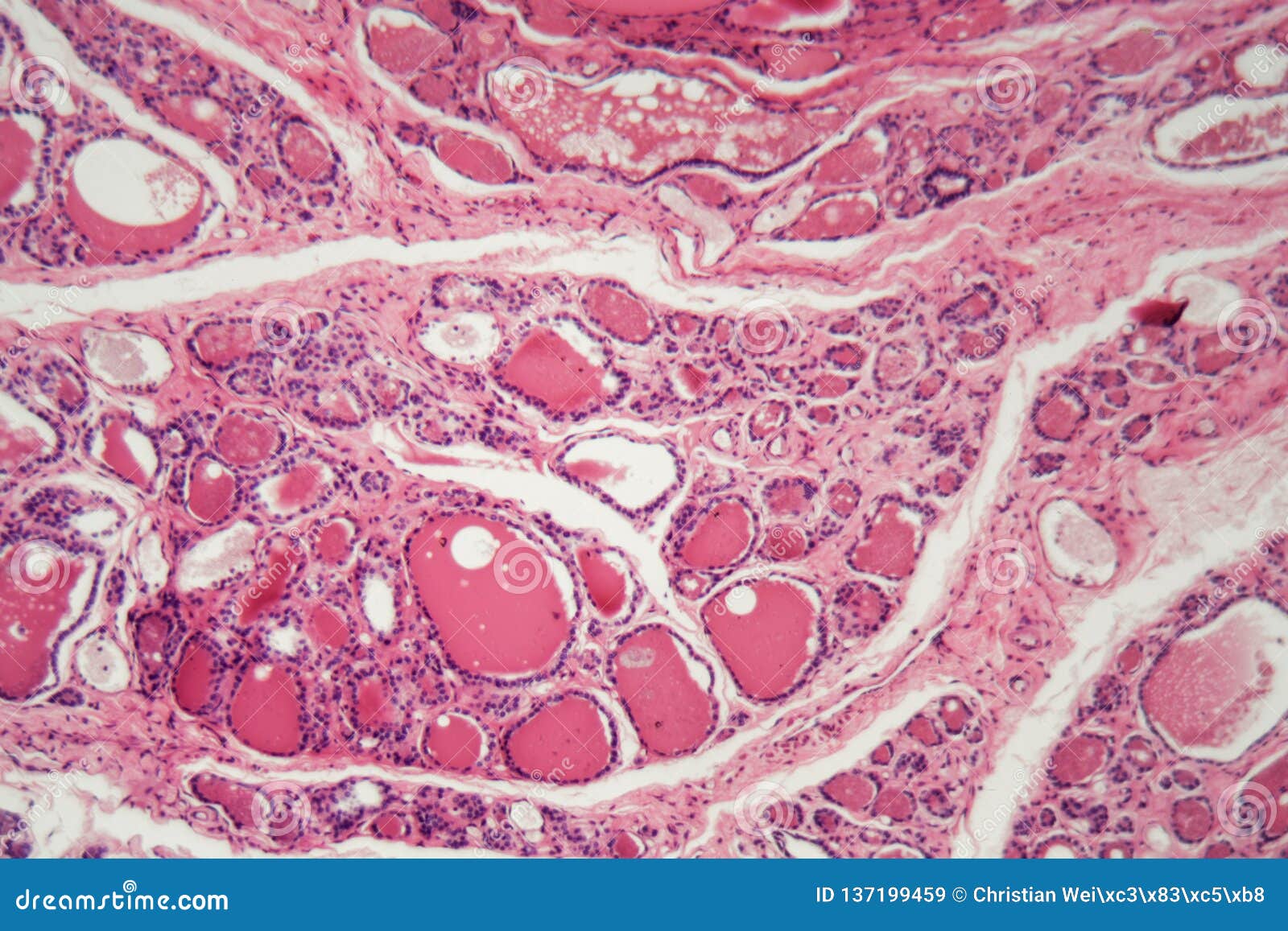 Cells Of A Human Thyroid Gland With Swelling Under A Microscope Royalty ...