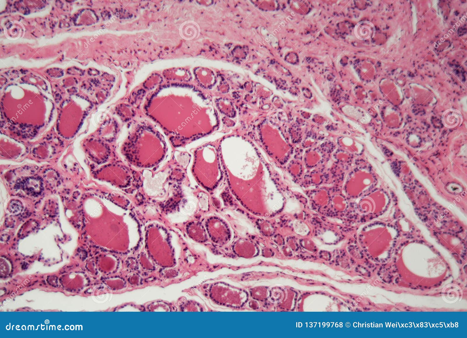 Cells of a Human Thyroid Gland with Swelling Under a Microscope Stock ...
