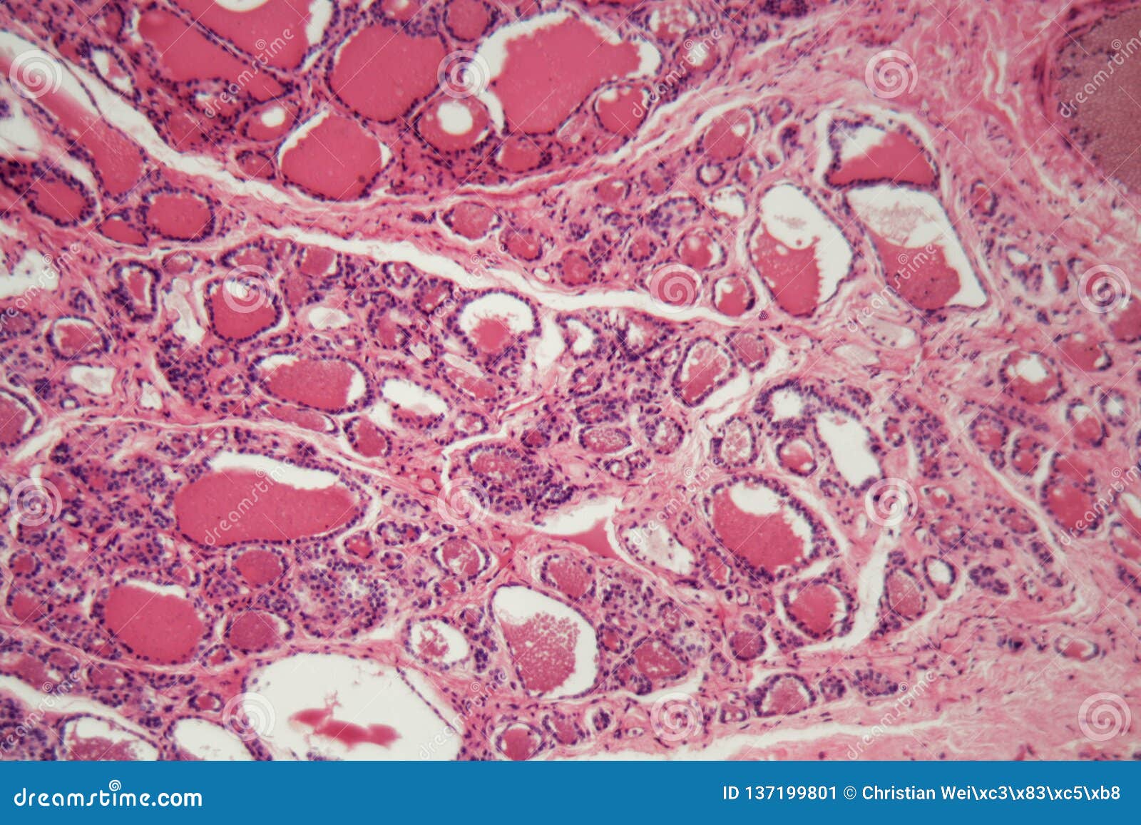 Cells of a Human Thyroid Gland with Swelling Under a Microscope Stock ...