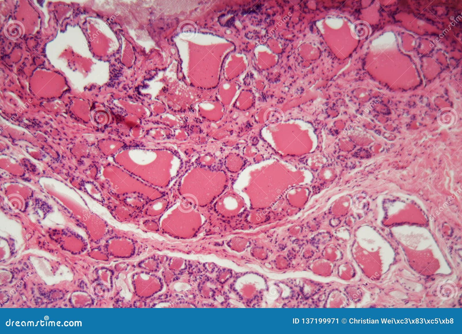 Cells Of A Human Thyroid Gland With Swelling Under A Microscope Stock Image Image Of Lump