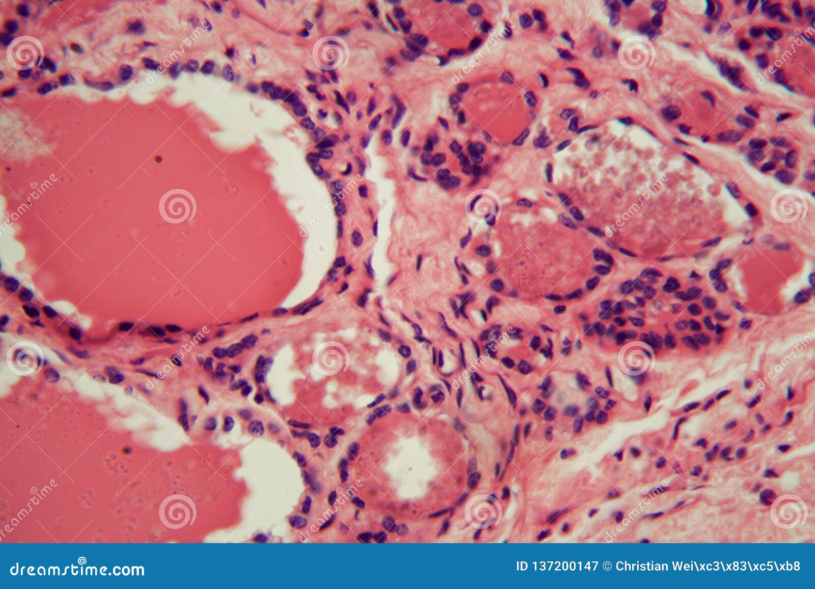 Cells of a Human Thyroid Gland with Swelling Under a Microscope Stock ...