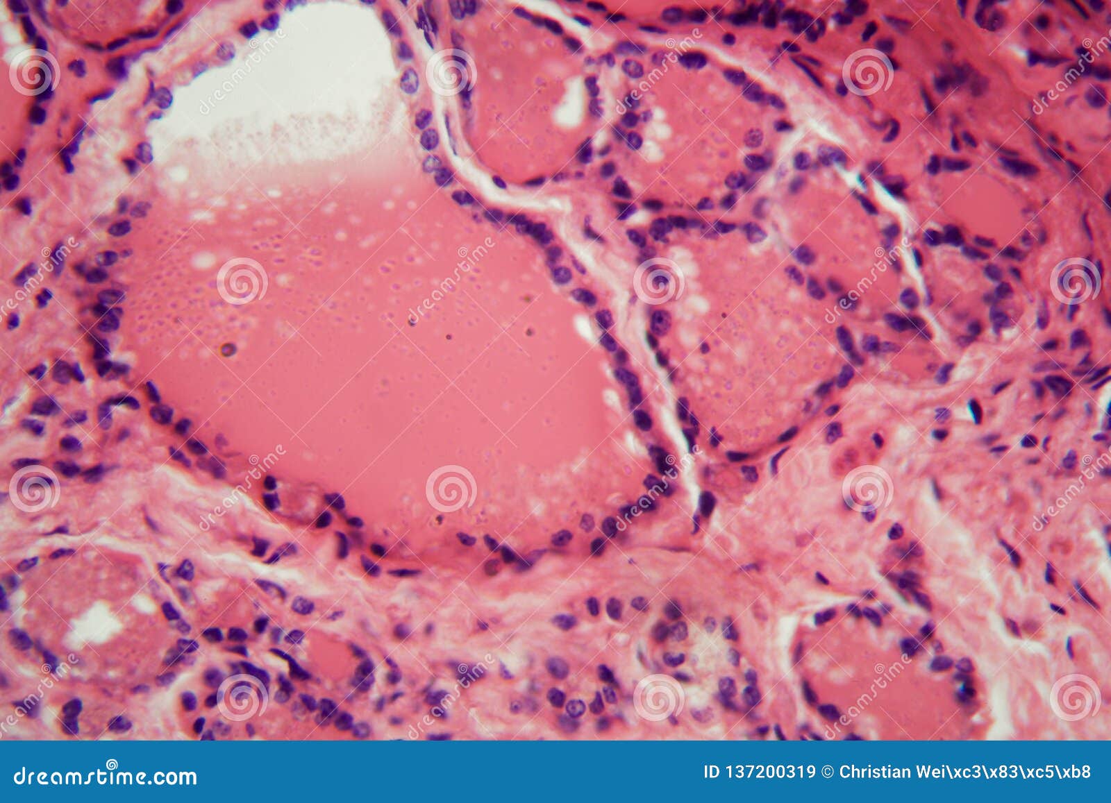 Cells Of A Human Thyroid Gland With Swelling Under A Microscope Stock Image Image Of Analysis