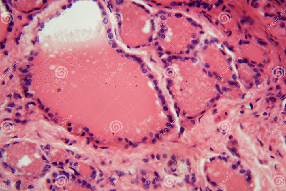 Cells of a Human Thyroid Gland with Swelling Under a Microscope Stock ...