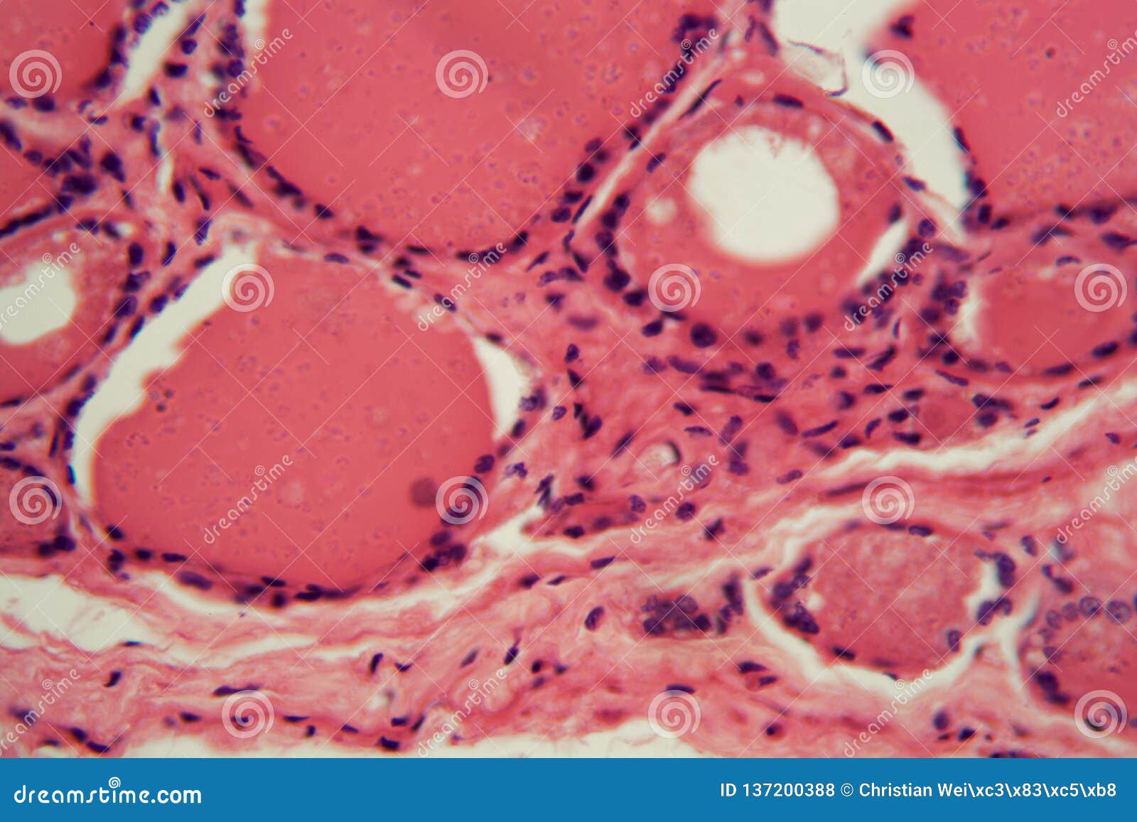 Cells of a Human Thyroid Gland with Swelling Under a Microscope Stock ...
