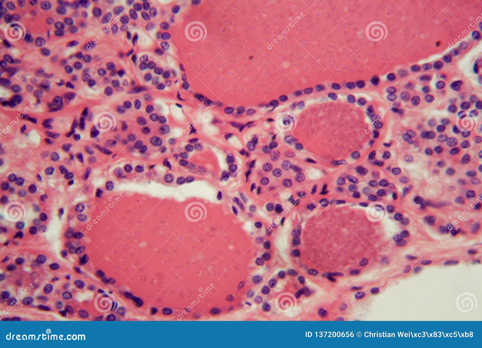 Cells Of A Human Thyroid Gland With Swelling Under A Microscope Stock ...