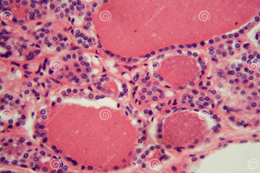 Cells of a Human Thyroid Gland with Swelling Under a Microscope Stock ...
