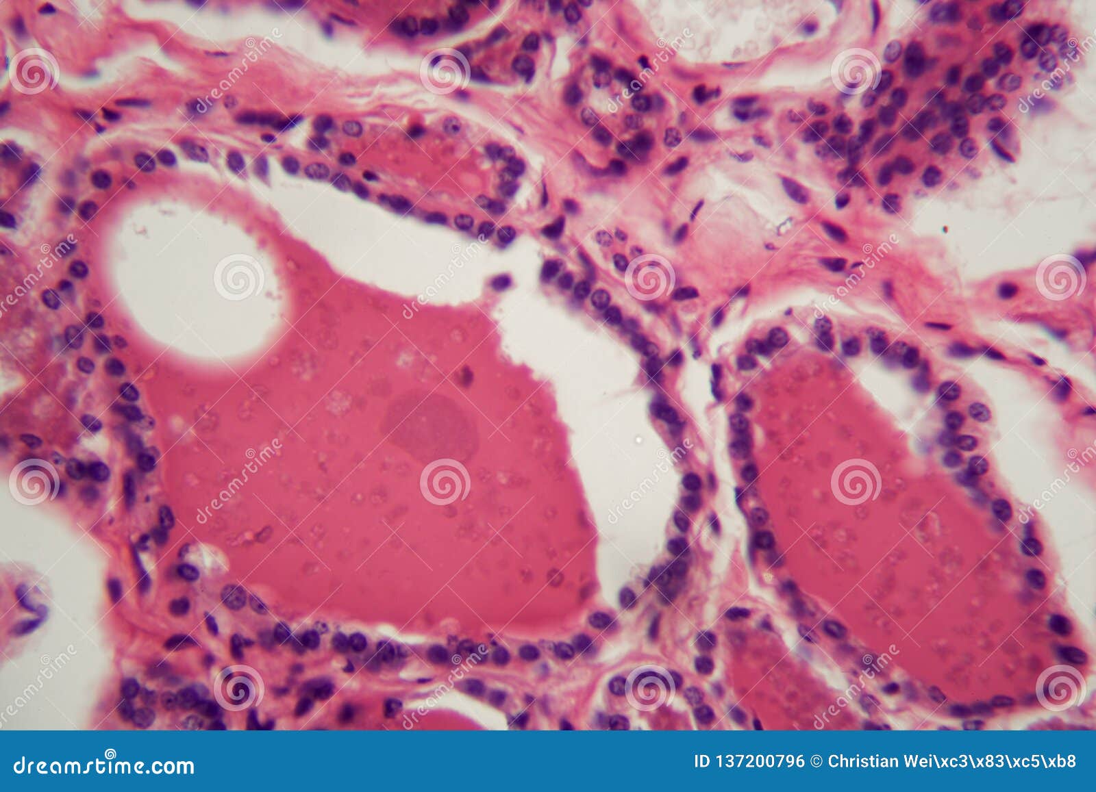 Cells of a Human Thyroid Gland with Swelling Under a Microscope Stock ...