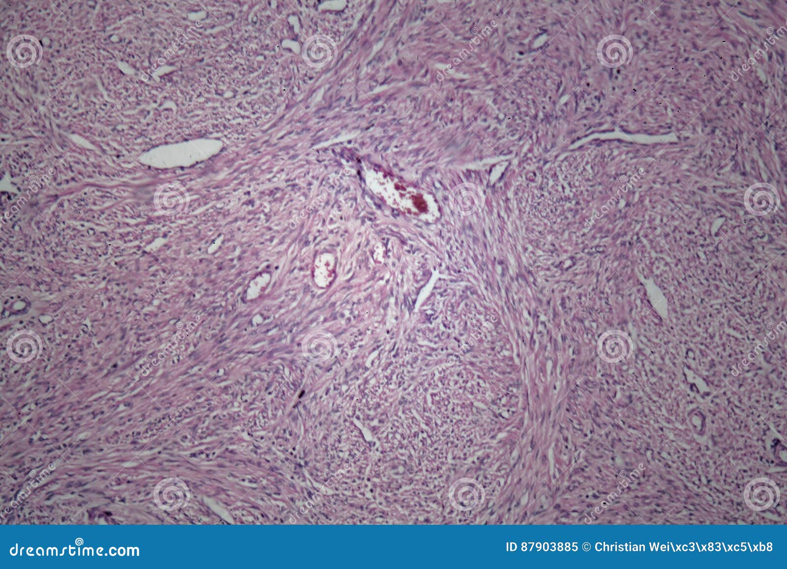 Human Uterus. Endometroid Carcinoma Royalty-Free Stock Photography ...