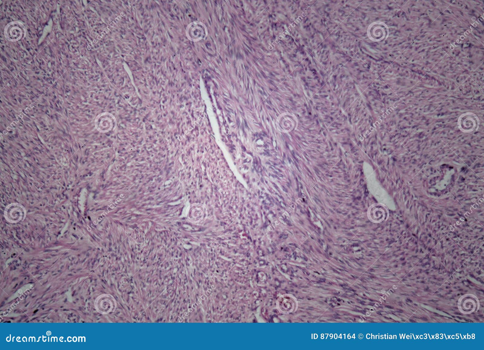 Human Uterus. Endometroid Carcinoma Royalty-Free Stock Photography ...