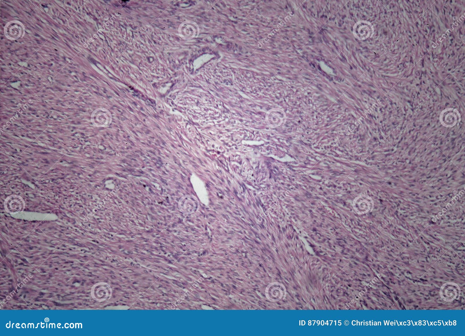 Human Uterus. Endometroid Carcinoma Royalty-Free Stock Photography ...