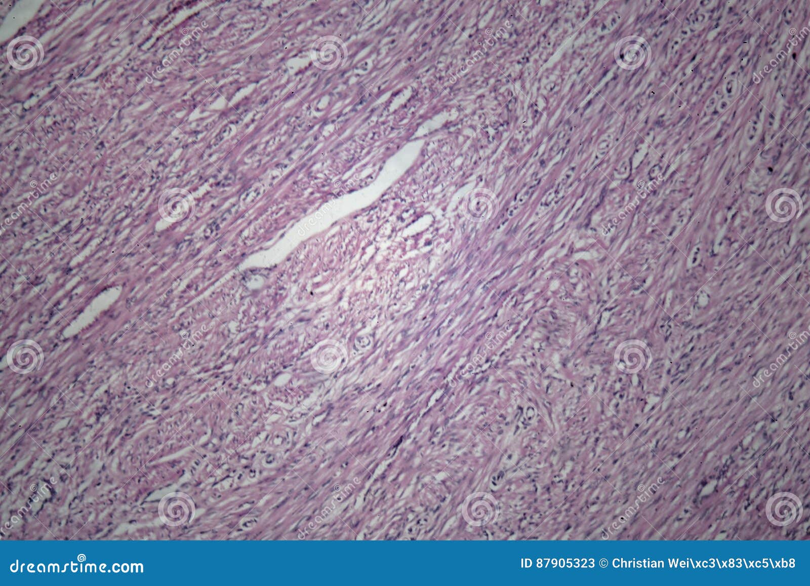 Cells of Human Uterus Tissue with Inoffensive Tumor Cells Stock Image ...