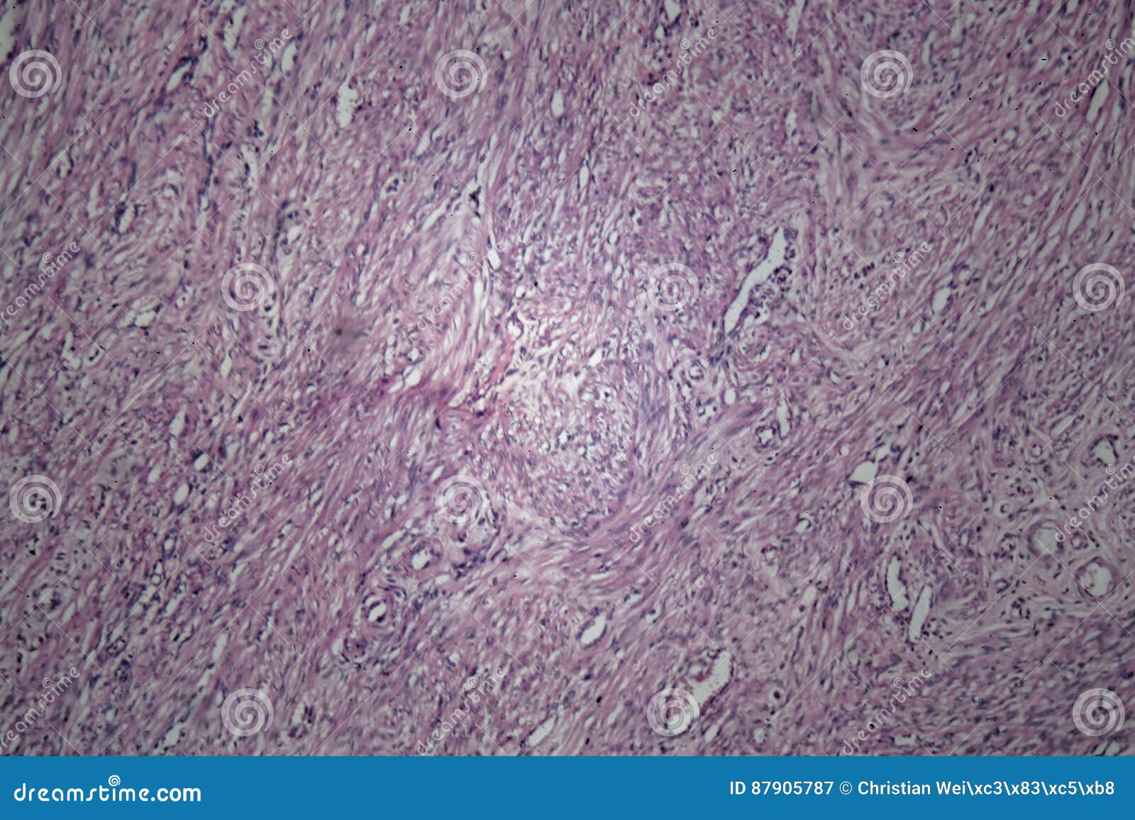 Cells of Human Uterus Tissue with Inoffensive Tumor Cells Stock Image ...