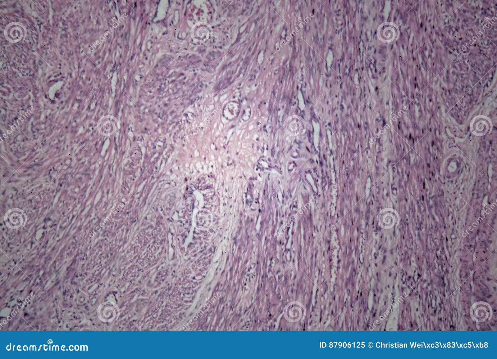 Cells of Human Uterus Tissue with Inoffensive Tumor Cells Stock Image ...