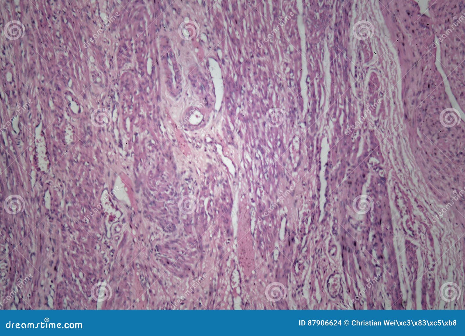 Cells of Human Uterus Tissue with Inoffensive Tumor Cells Stock Photo ...