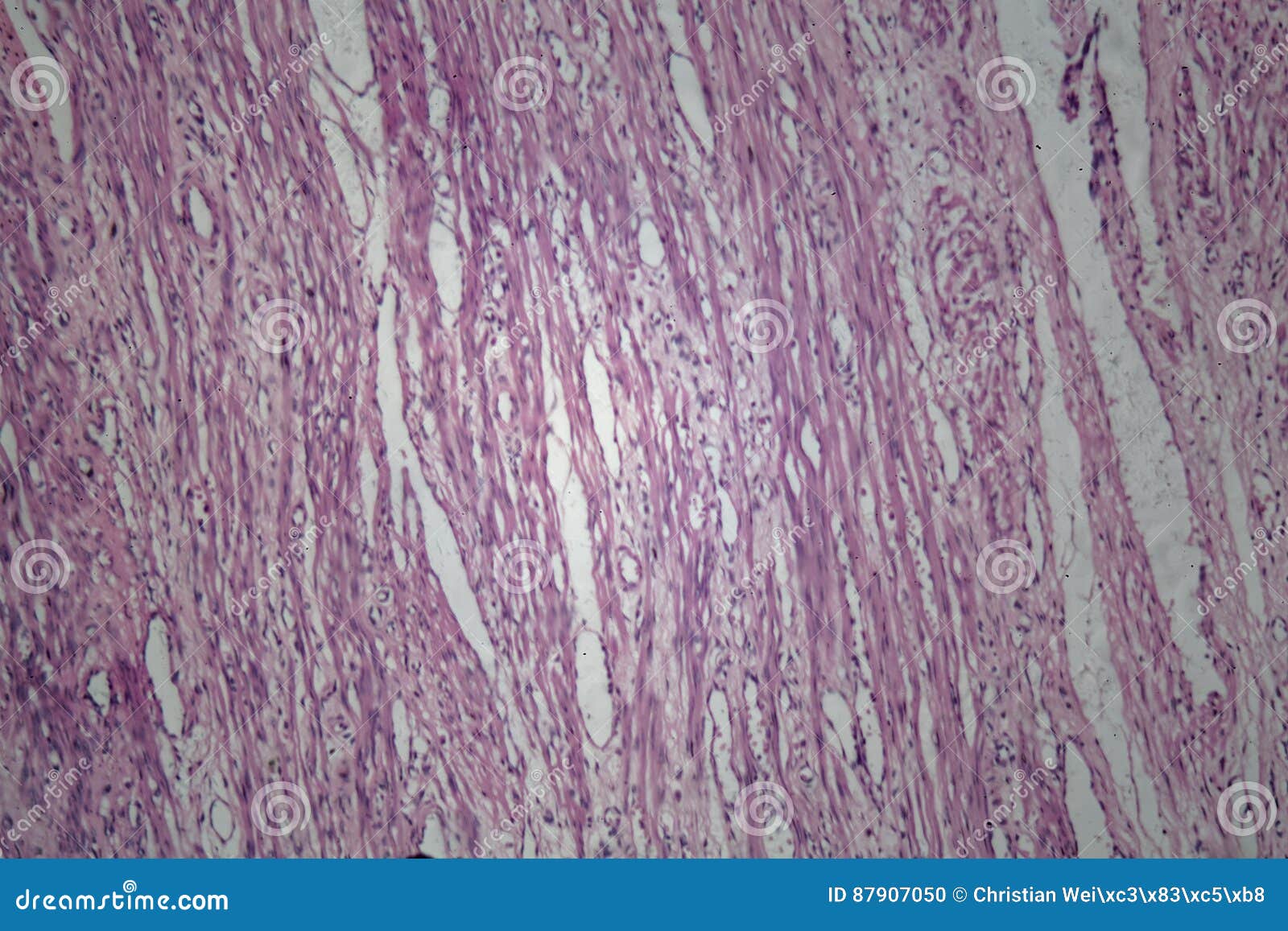 Cells of Human Uterus Tissue with Inoffensive Tumor Cells Stock Photo ...
