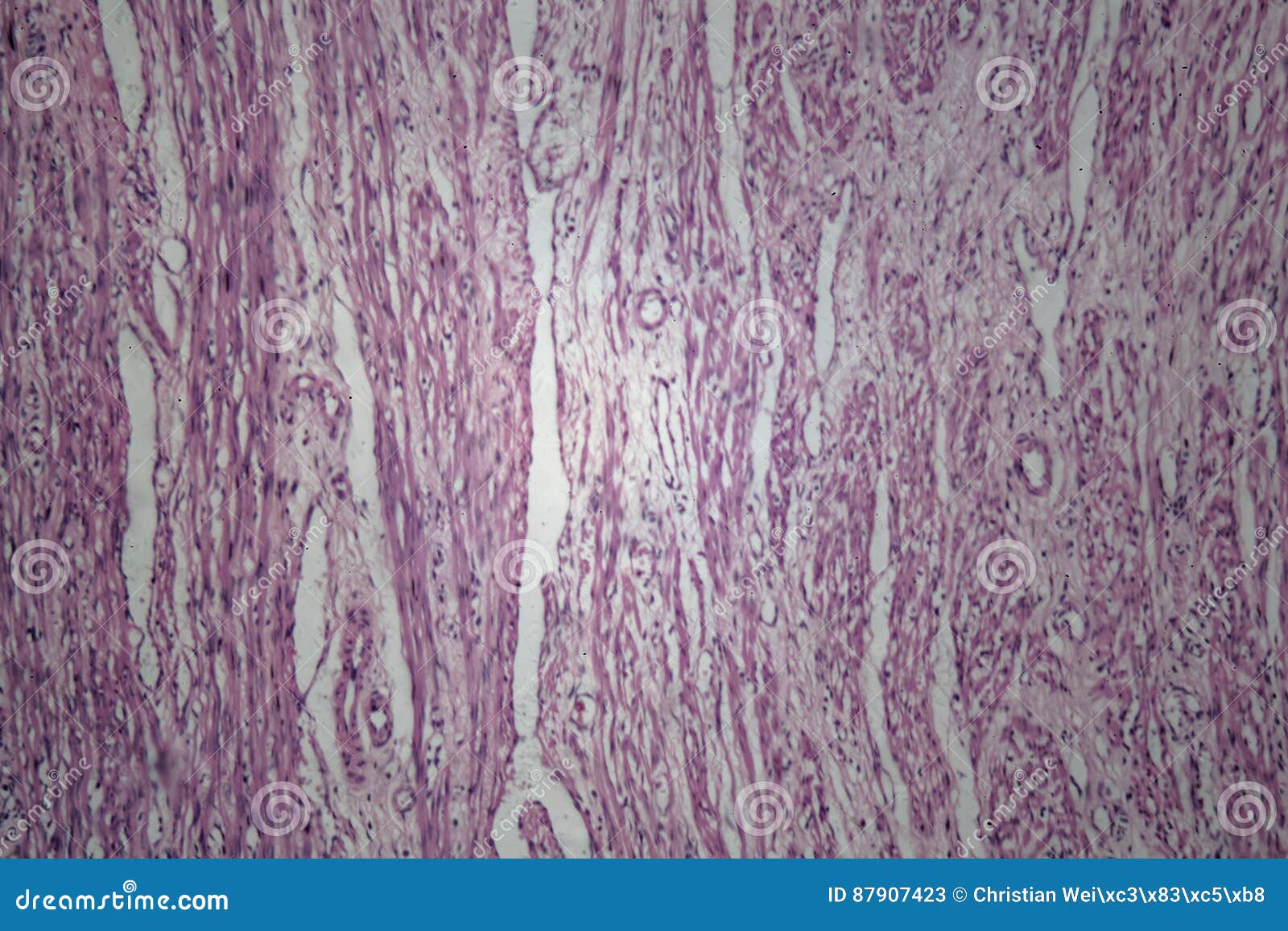 Cells of Human Uterus Tissue with Inoffensive Tumor Cells Stock Image ...