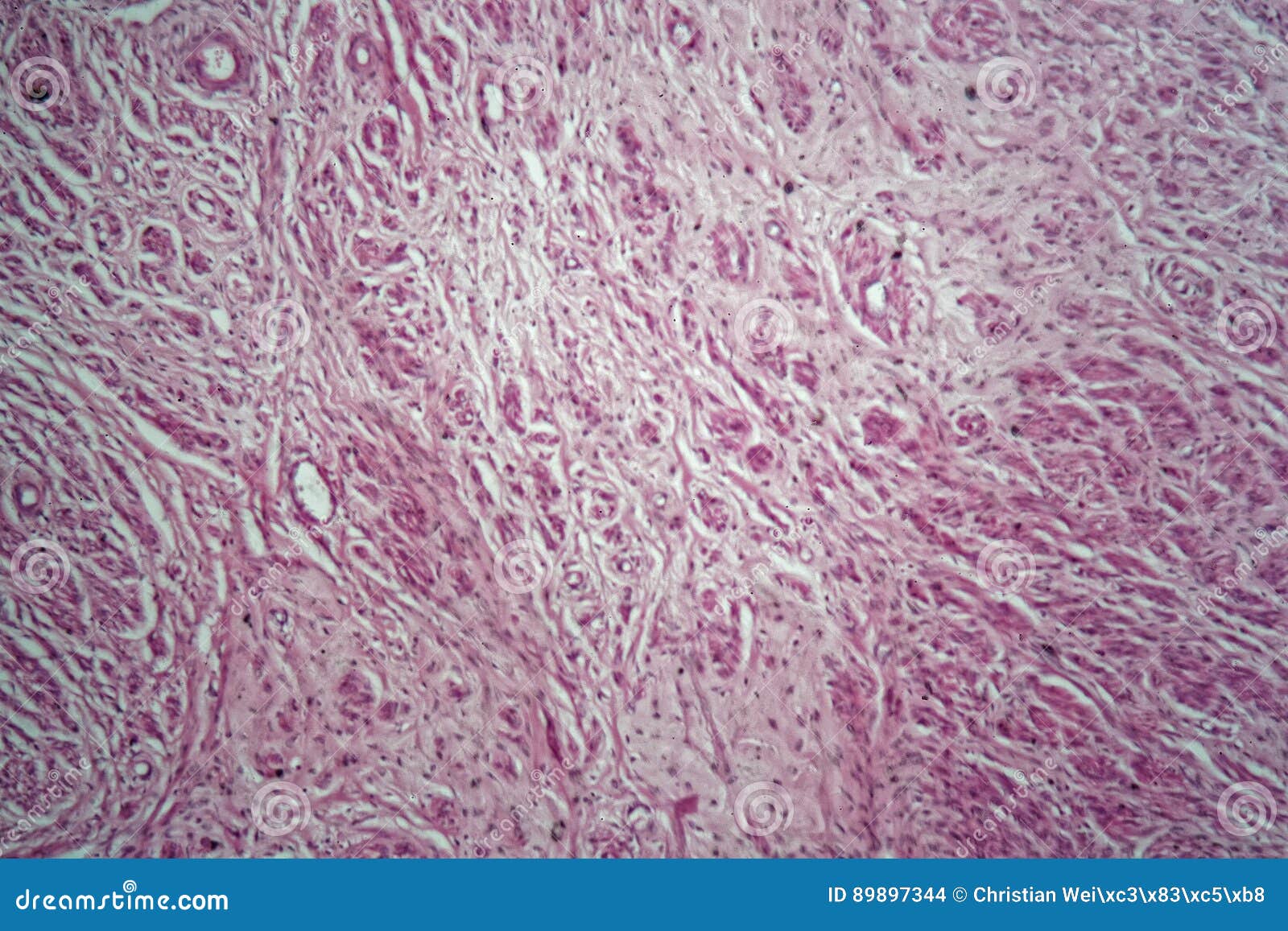 Cells of a Human Uterus with Uterine Fibroids Stock Photo - Image of ...