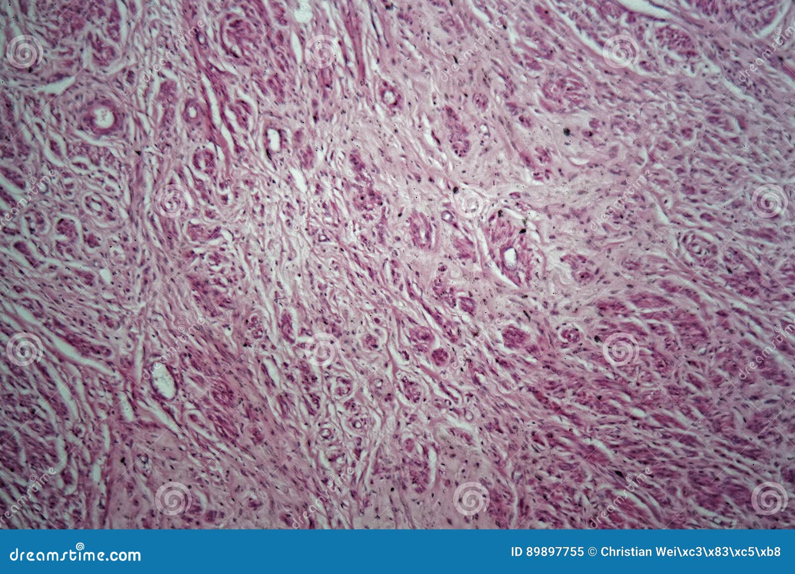 Cells of a Human Uterus with Uterine Fibroids Stock Image - Image of ...