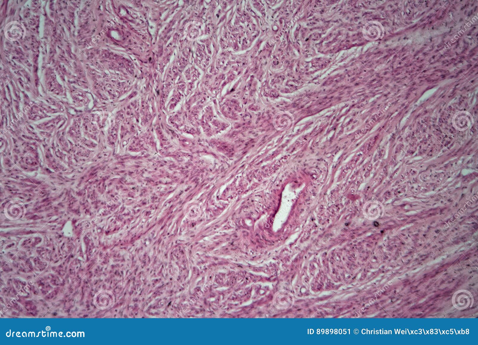 Cells of a Human Uterus with Uterine Fibroids Stock Image - Image of ...