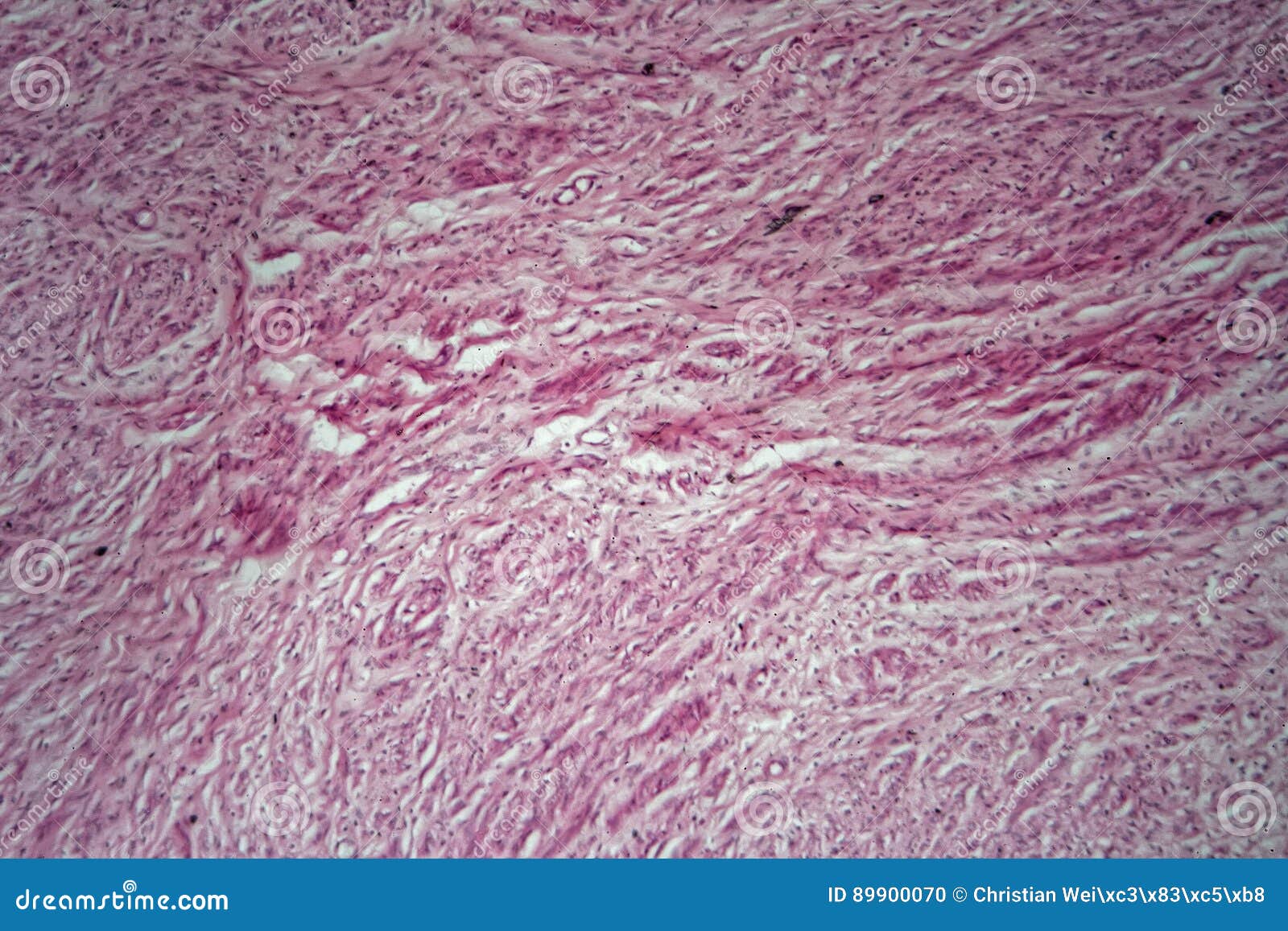 Fibromyoma Of The Uterus Diseased Tissue Stock Photo | CartoonDealer ...