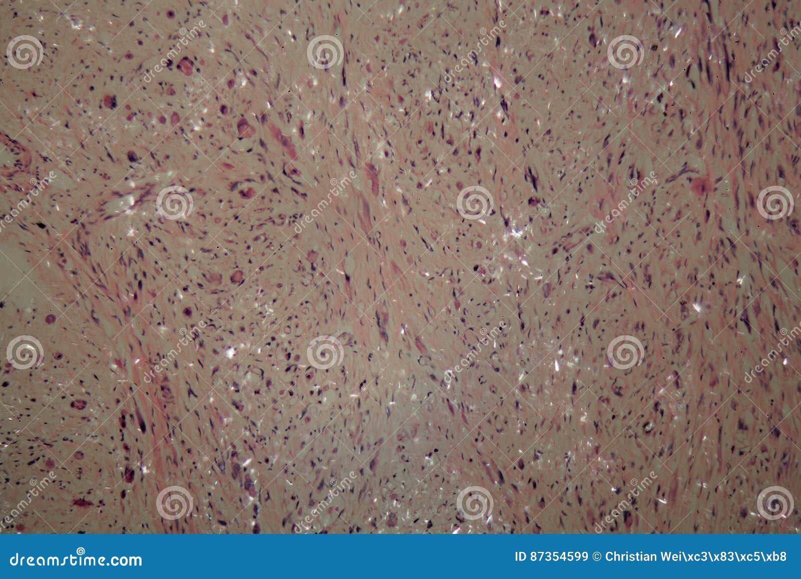 Cells Of Testicular Cancer Royalty-Free Stock Photo | CartoonDealer.com ...